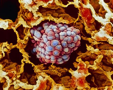Inoperable Lung Cancer Associated With Longer Survival Under Combined Modalities