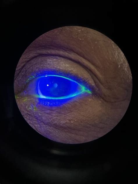 Treating Herpetic Keratitis Os With Aurora Ophthalogix