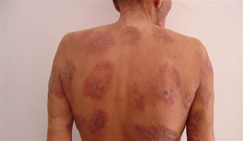 麻风病的症状图片麻风病图片大全麻风病39疾病百科