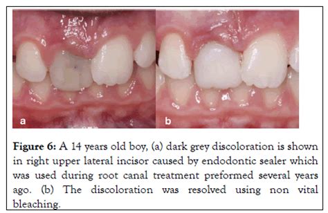 Tooth Discoloration In The Young Dentition A Literature Review