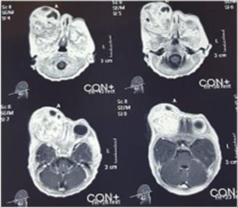 Axial T1 Post Contrast Mri Showing A Heterogenous Mass In Right Orbit