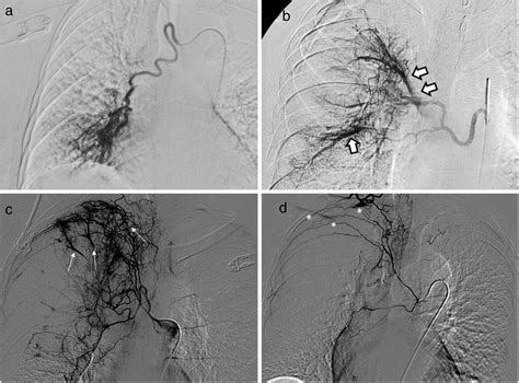 Embolization Of Bronchial Arteries And Nonbronchial Systemic Arteries