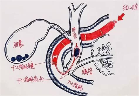 知識要更新，別只知道膽囊結石，你了解膽總管結石嗎？ 每日頭條