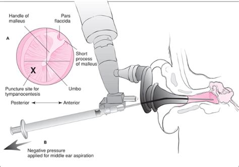 Tympanocentesis Obgyn Key