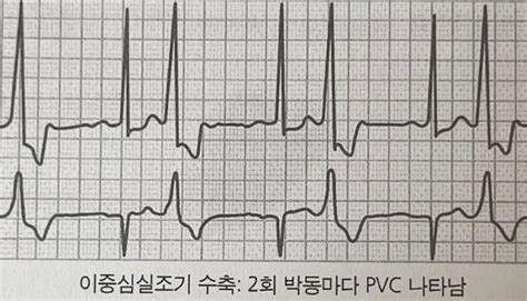심실조기수축 의학용어 Pvc Vpc Premature Ventricular Contraction Ekg 리듬