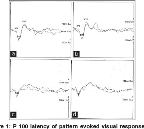 Figure 1 From Reversible Cerebral And Brain Stem Dysfunction In N