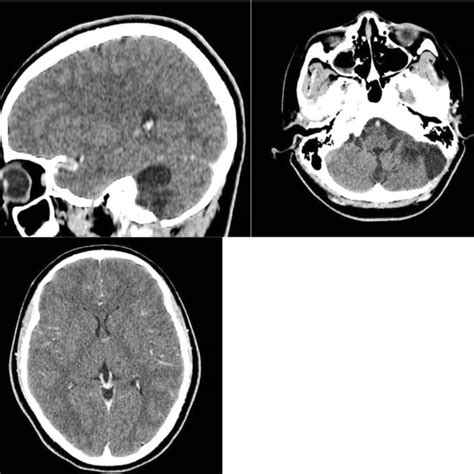Overview Of Choroid Plexus Tumors Download Table