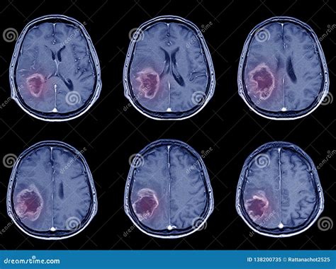 Ct Scan Of Brain Black And White Vector Graphic