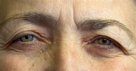 Upper Blepharoplasty Recovery Photos Day By Day Leva Medical