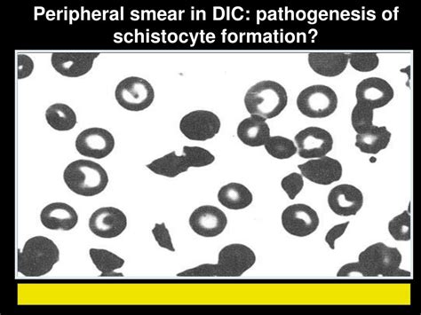 PPT First Foundations In Pathology Part 4 Hemodynamic Disorders