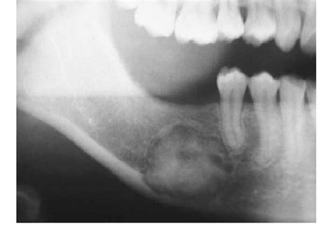 Ossifying Fibroma