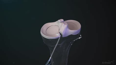 Arthrex Meniscal Root Repair Using The Sutureloc™ Implant For A Mason