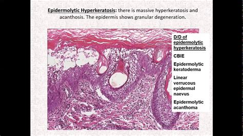 Lecture 57 Inherited Disorders Of Cornification Part 3 Non Syndromic Keratodermas Rooks Ch