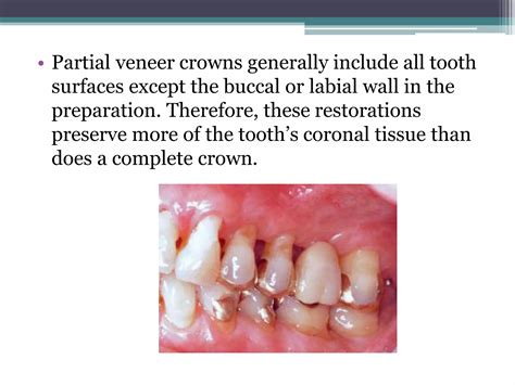 Tooth Preparation For Partial Veneer Crwns Pptx