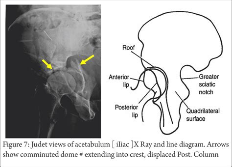 Understanding Clinical Radiology Of Fracture Acetabulum Trauma International