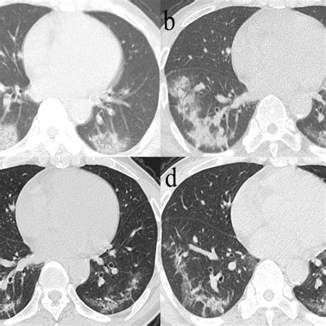 Series Ct Scans In A 65 Year Old Man With Covid 19 Pneumonia A Scan