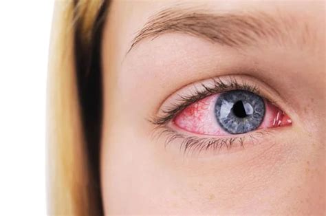Tips On Making Red Veins In The Eyes Go Away Wellnessbin