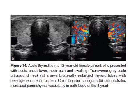 Thyroid Usg Dos 1 Pptx