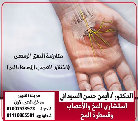 ⭕ متلازمة النفق الرسغي إختناق العصب الأوسط باليد 👈 يا دكتور أنا مراتي إيدها اليمين بتنمل