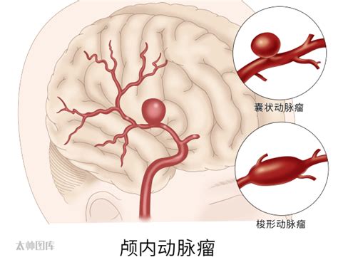 颅内动脉瘤 医学插画