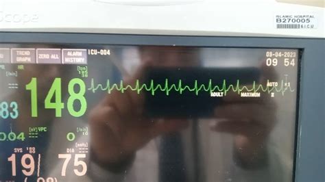 Jamal Mustafa Md En Linkedin Paroxysmal Supraventricular Ventricular