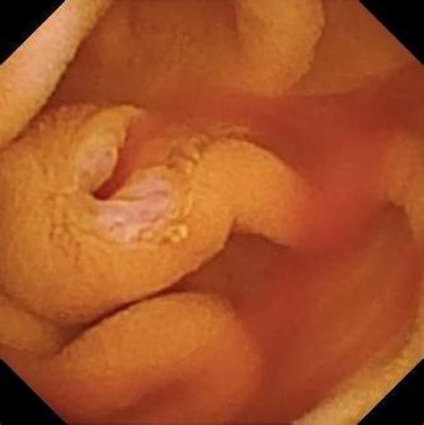 Capsule Endoscopy Showing Fresh Blood From An Otherwise Normal