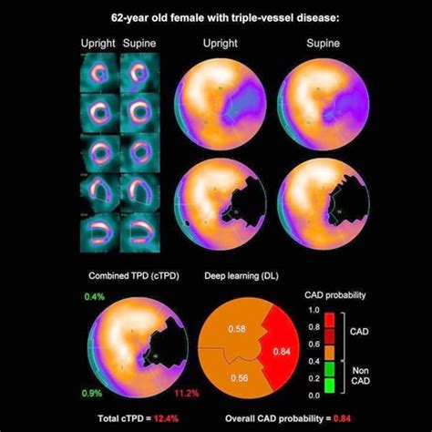 Tmt Test Centre Near You In Delhi Book At Low Price Ganesh Diagnostic