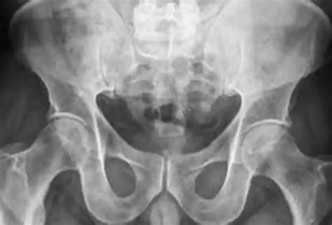 Radioactive Seed For Prostate Cancer Treatment Watch Webmd Video