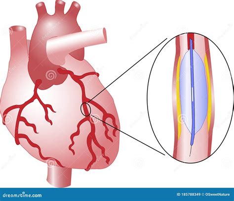 Atherosclerosis Fibrous Plaque Formation Vector