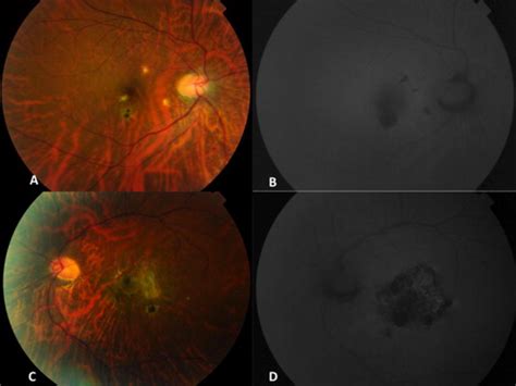 Fundus Photograph Of The Right Eye Showing Choroiditis Patches In A Download Scientific Diagram