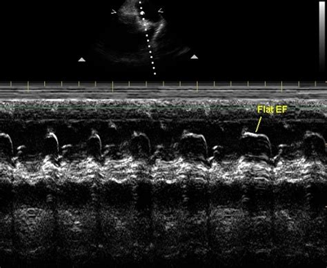 Echocardiographic Profile In Pulmonary Hypertension