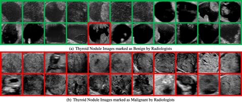 Figure 1 From Thyroid Nodule Ultrasound Image Classification Through