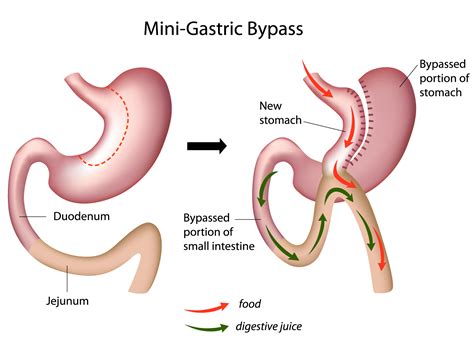 Laparoscopic One Anastomosis Gastric Bypass Oagbmgb Gbmc Jordan