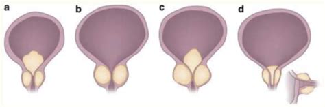 Benign Prostatic Hyperplasia Bph Overactive Bladder Oab And Incontinence Flashcards Quizlet