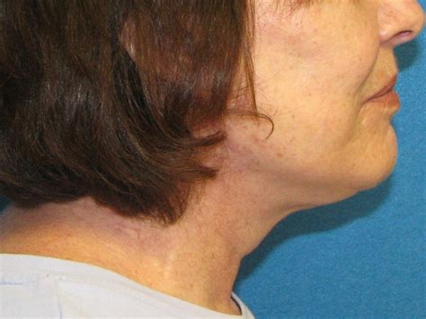 Faceliftneck Lift Rhytidectomy Before And After Gallery Awaken