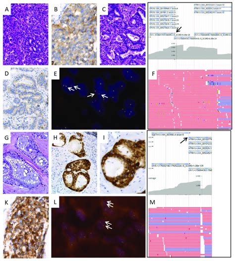 Morphologic And Molecular Characteristics Of Ntrk Fusion Positive Lung