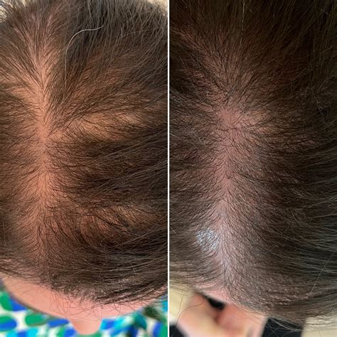 Hair Loss Treatment Trikhos Hair Lab