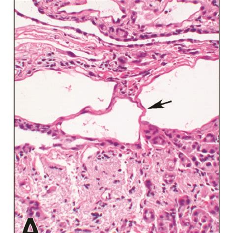 Photomicrographs Of D2 40 Immunohistochemical Ihc Stain D2 40 Ihc Is