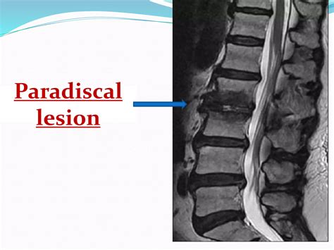 Tuberculosis Of Spine Potts Spine Pptx
