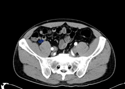 Ct 0019 Bowel Appendix Differential Diagnosis Of