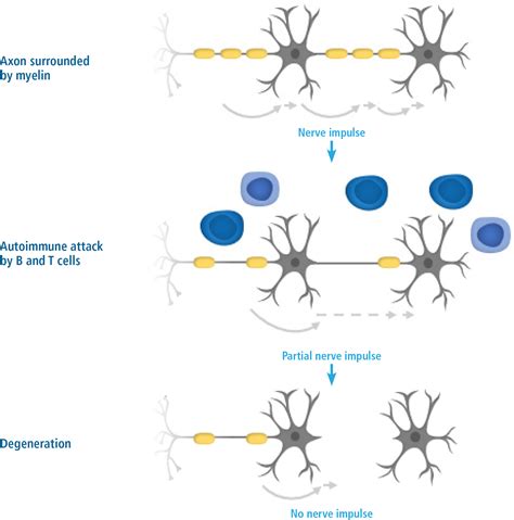 Multiple Sclerosis In Primary Care Diagnosis And Early Treatment Issues And Answers