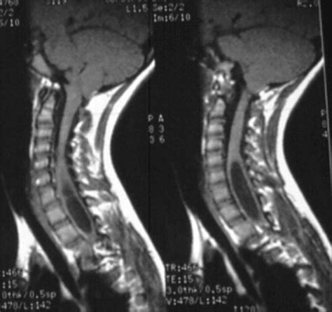 49 Osteotomies Of The Foot For Cavus Deformities Musculoskeletal Key