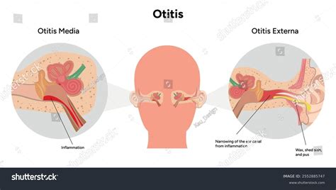 Otitis Media Externa Inflammation Anatomy Human Stock Vector Royalty