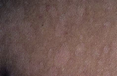 Лишай Жибера Лечение Фото — Картинки фотографии