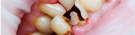 Rotten Teeth Causes Consequences And Treatments