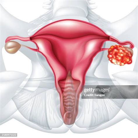 Cervical Cancer High Res Vector Graphic Getty Images