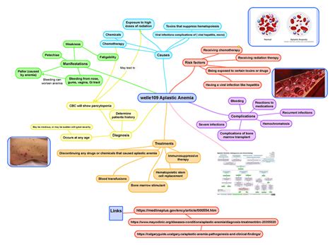 Welle 109 Aplastic Anemia Concept Mapa Bleeding Can Worsen Anemia Welle109 Aplastic Anemia