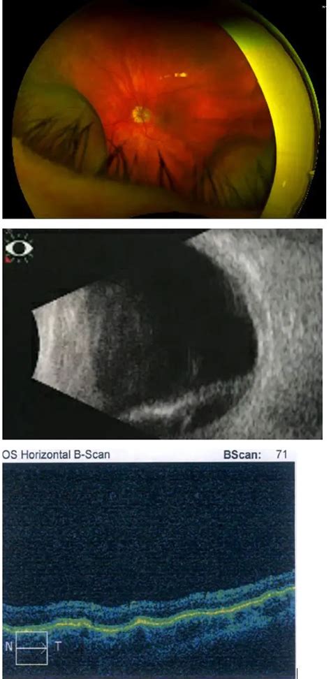 Choroidal Effusion American Academy Of Ophthalmology