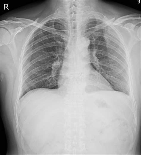 La Radiografía Del Pecho Fractura La Clavícula Izquierda La 2da