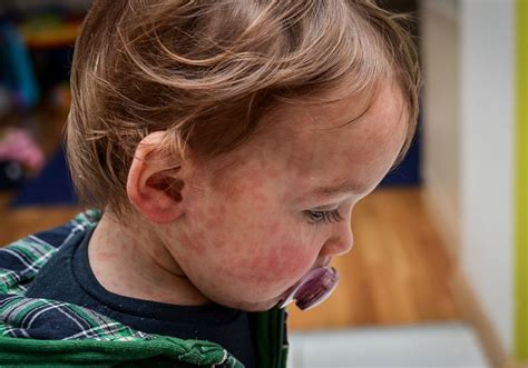 Immune Amnesia How The Texas Measles Outbreak Could Promote The Spread
